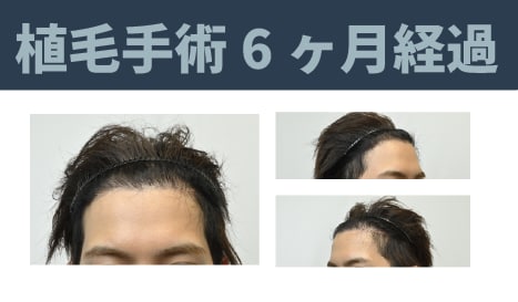 お盆休みに関西で植毛をお考えの方 - 湘南AGAクリニック大阪院-AGA治療・薄毛治療・自毛植毛