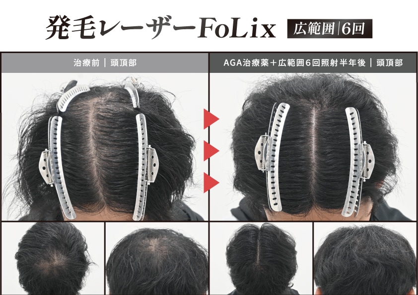 【解説】発毛レーザーFoLix（フォリックス）の効果を実際の写真から解説